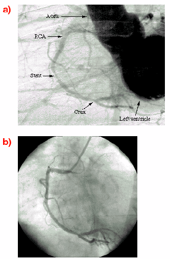 First Human Coronary Angiography at the ESRF