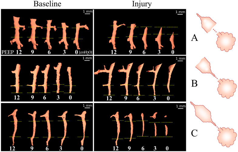 Direct evidence of small airway closure in acute respiratory distress ...